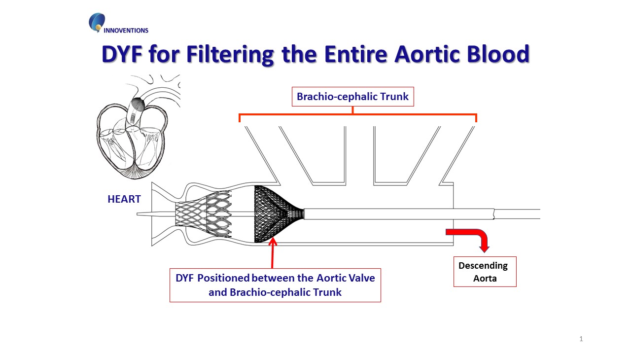 Novel Emboli Capturing and Removal Double-Filtering System for Whole ...